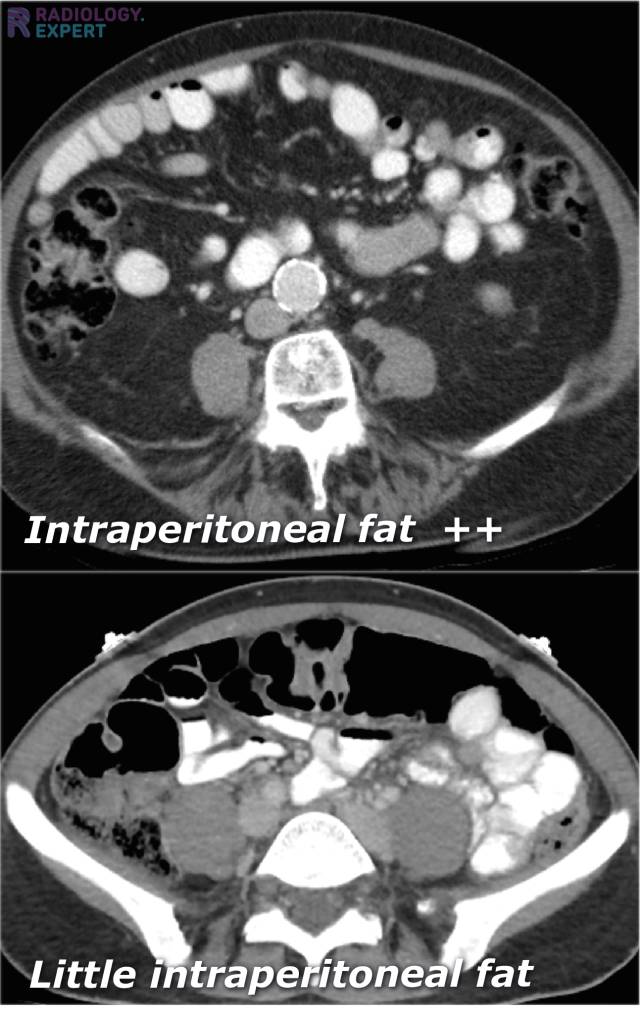 CT abdomen general